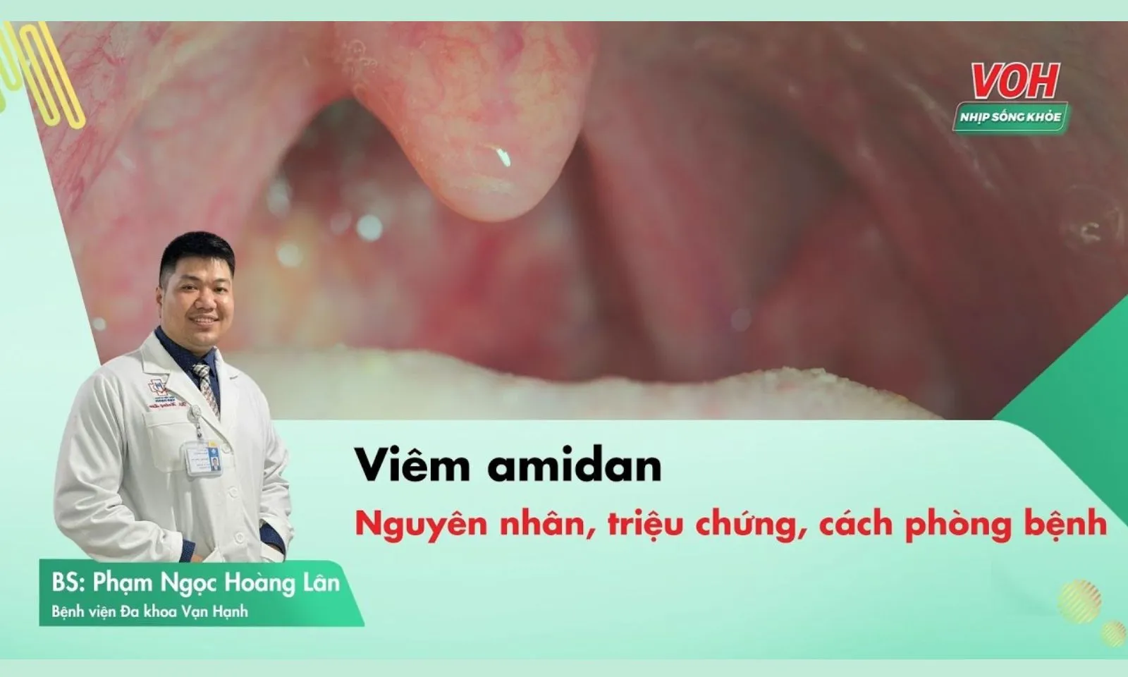 Viêm amidan: Nguyên nhân, triệu chứng và cách phòng amidan hiệu quả