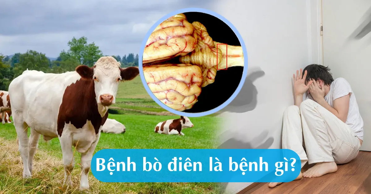 Bệnh bò điên là gì, ai có nguy cơ mắc bệnh?