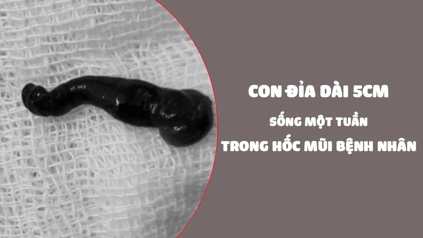 Con đỉa dài 5cm sống trong hốc mũi thiếu niên ở Nghệ An