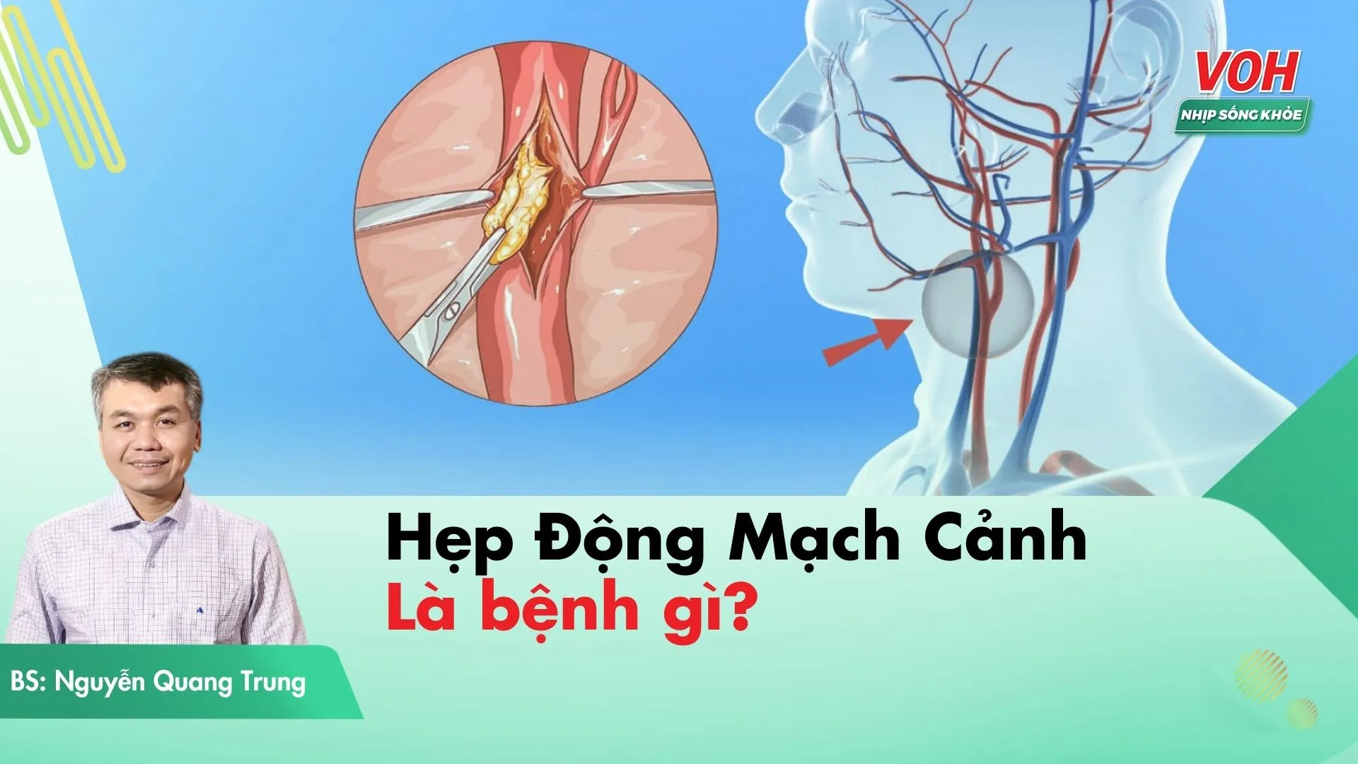 Tìm hiểu bệnh hẹp động mạch cảnh là gì? Nguy hiểm không?
