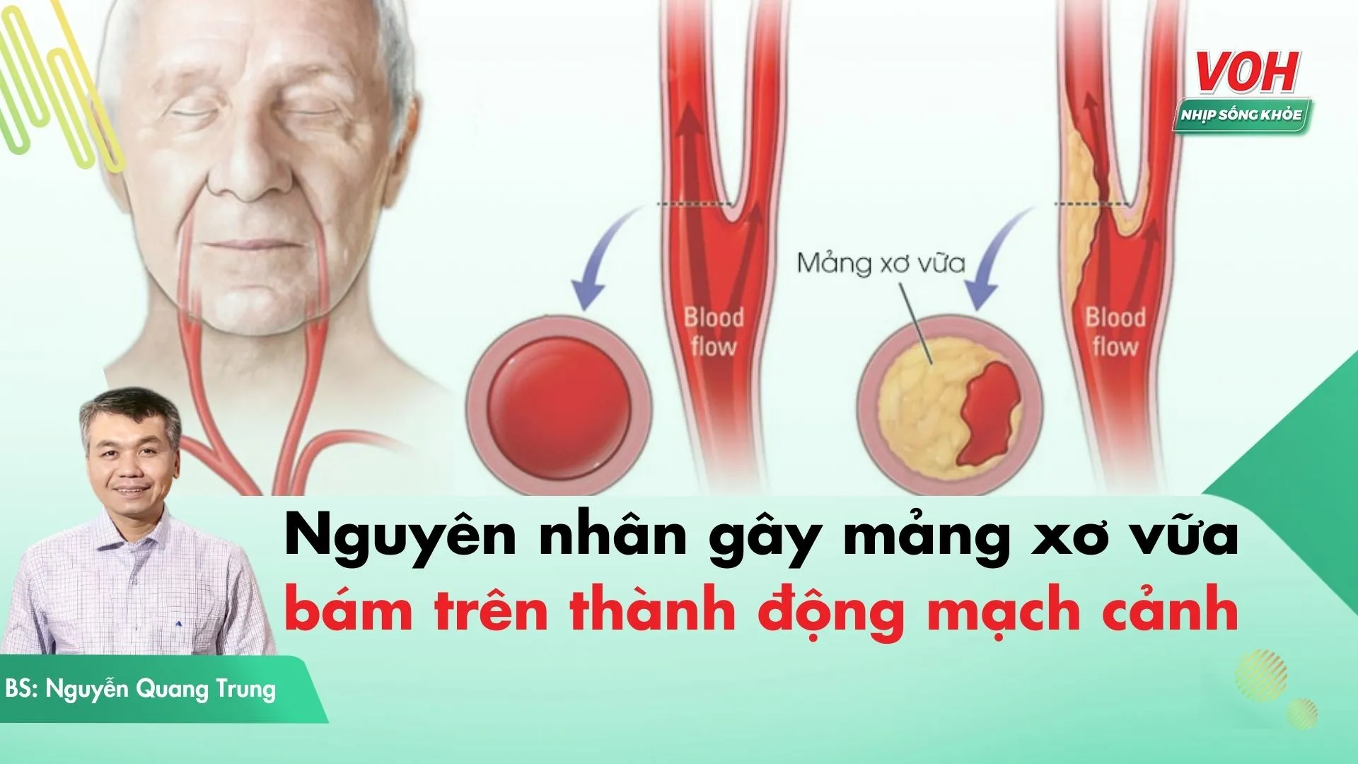 Lý do hình thành mảng xơ vữa ở động mạch cảnh